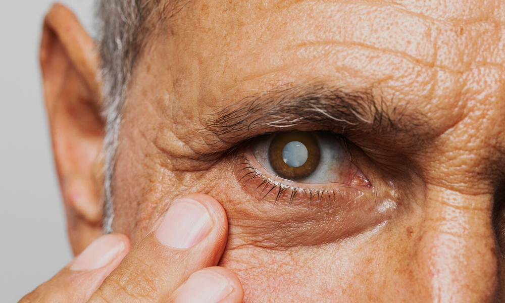 Foggy Vision: A Closer Look at Pseudophakic Bullous Keratopathy